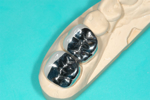 Porcelain fused to metal crown